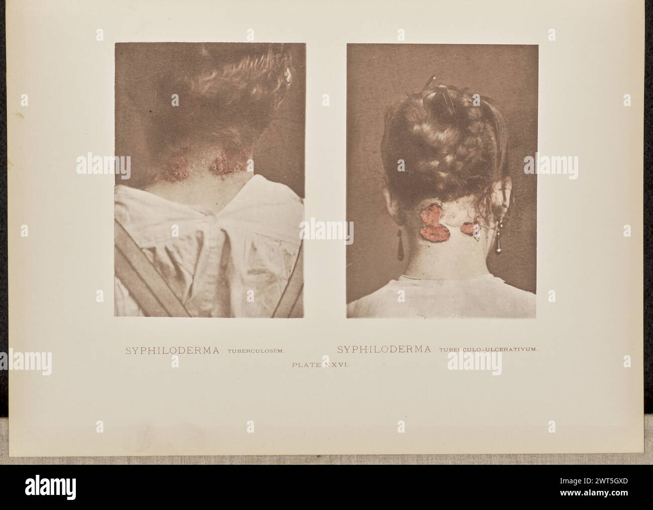 Syphiloderma tuberculosum and syphiloderma tuberculo-ulcerativum. Dr ...