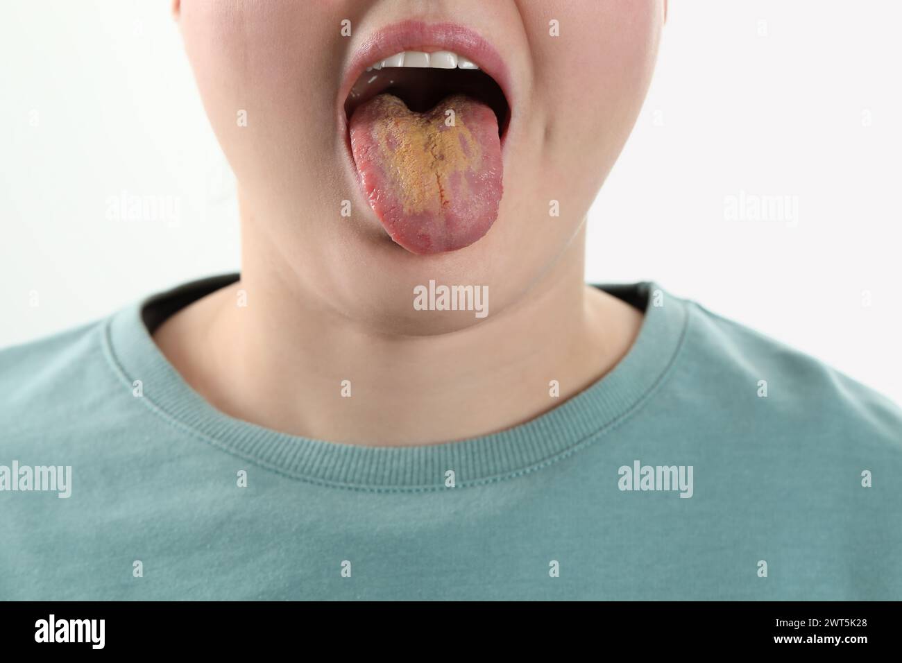 Gastrointestinal diseases. Woman showing her yellow tongue on white ...