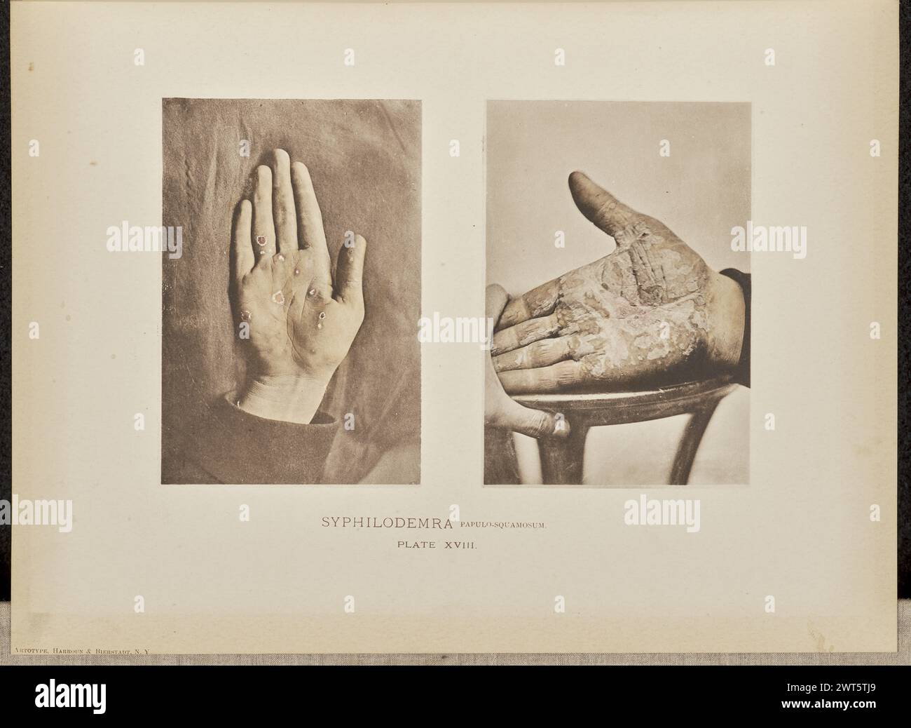 Syphiloderma papulo-squamosum. Dr. George Henry Fox, photographer ...