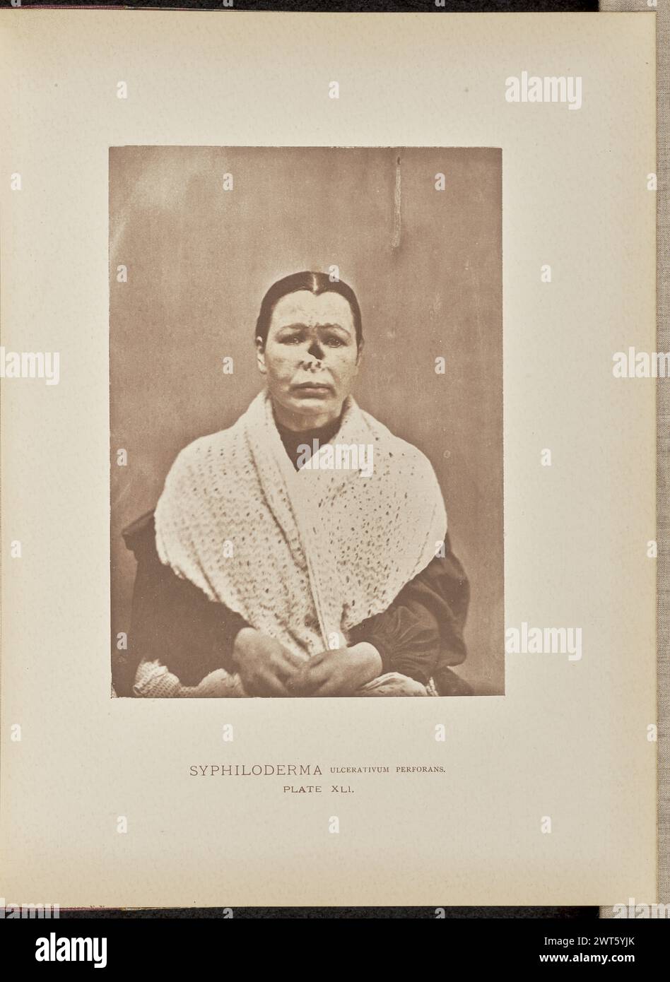 Syphiloderma ulcerativum perforans. O.G. Mason, photographer (American ...