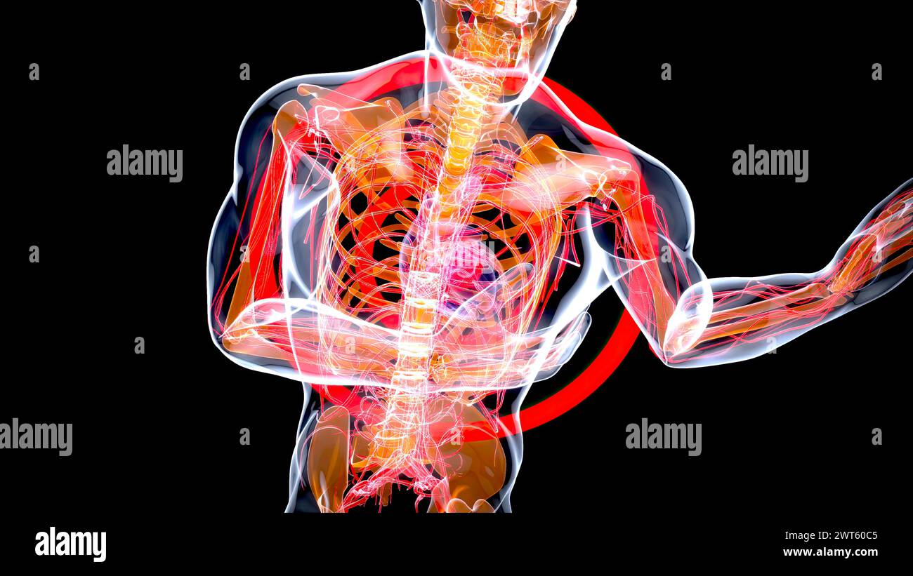 Heart attack, conceptual illustration Stock Photo - Alamy