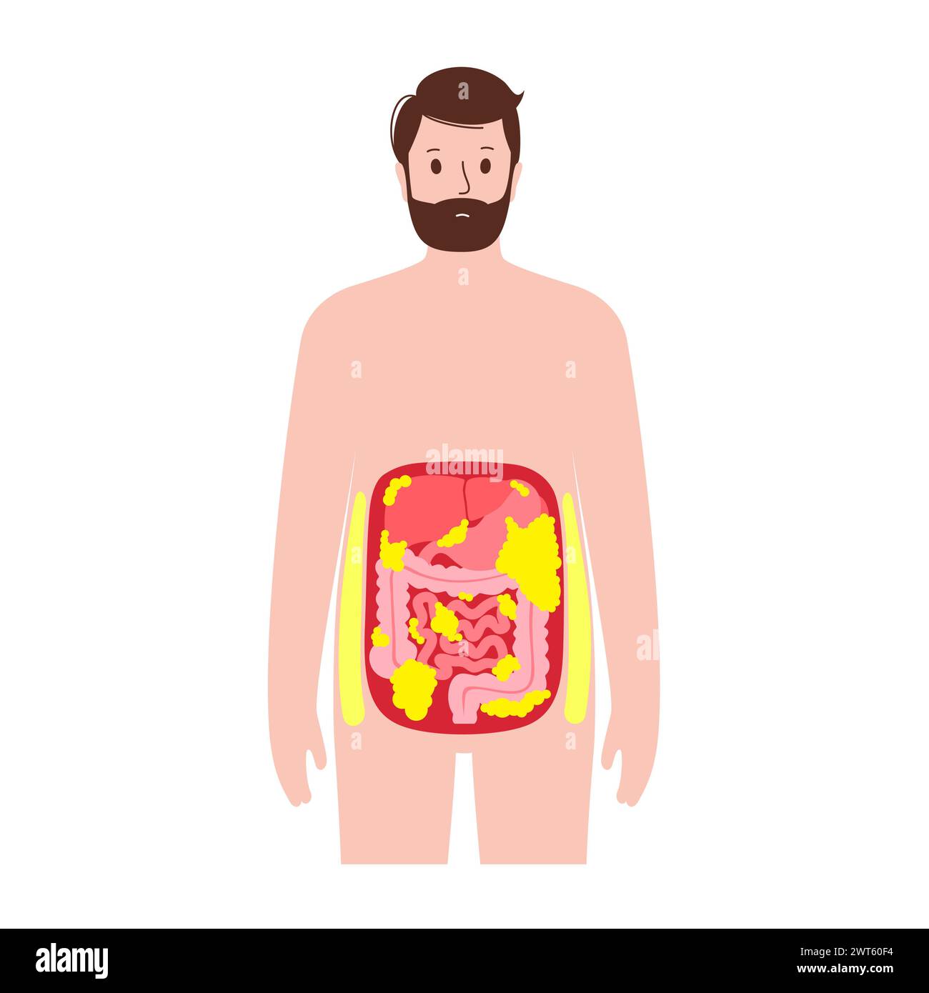 Visceral Fat Diagram Illustration Belly Fat Surrounds Internal Organs In Abdominal Cavity