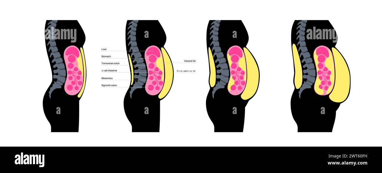 Visceral fat diagram, illustration. Belly fat surrounds internal organs ...