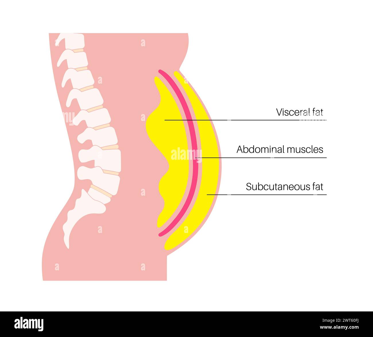 Visceral fat diagram, illustration. Belly fat surrounds internal organs ...