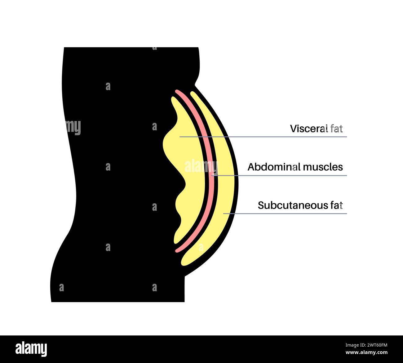 Visceral fat diagram, illustration. Belly fat surrounds internal organs ...