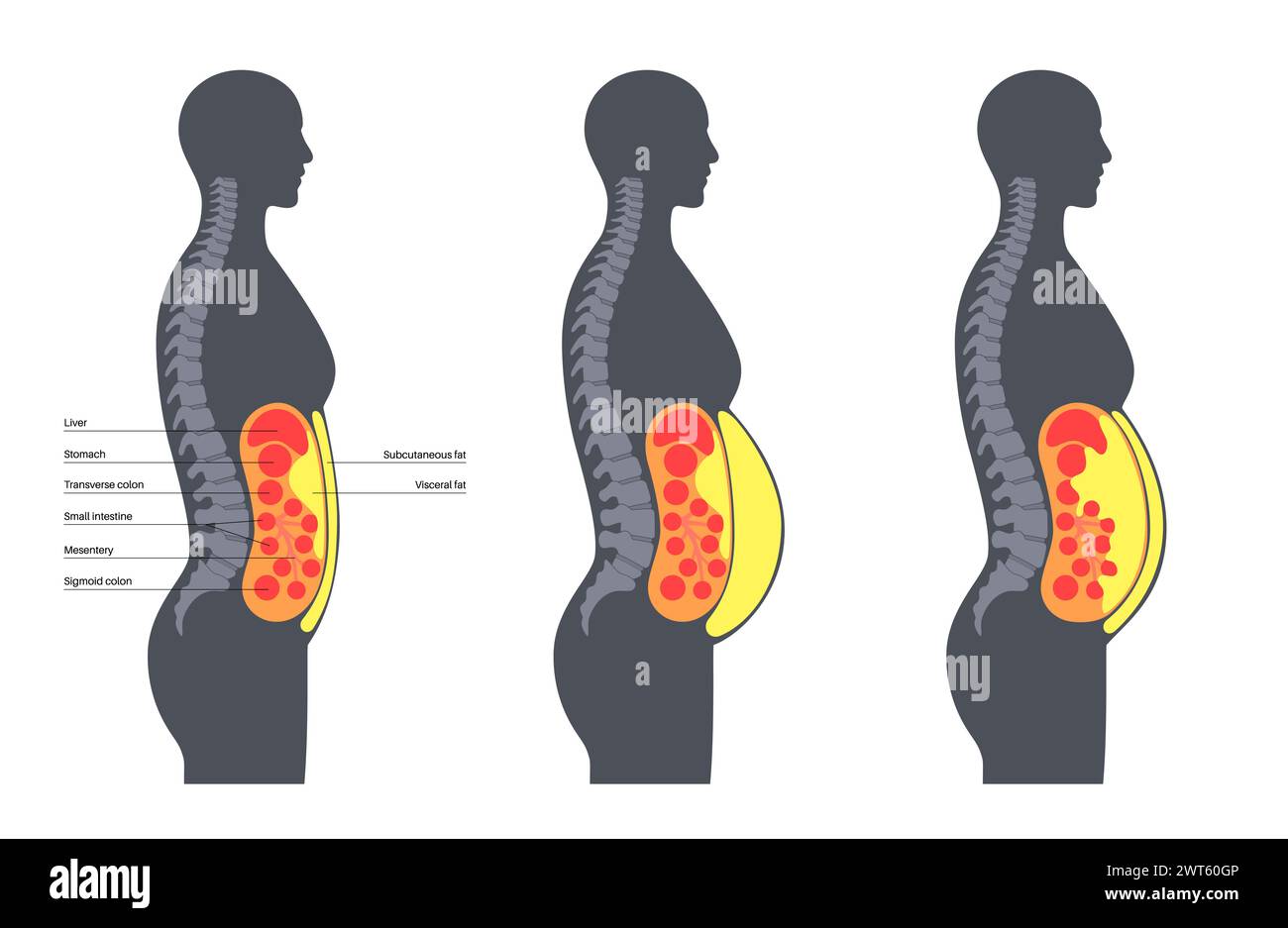 Visceral fat diagram, illustration. Belly fat surrounds internal organs ...