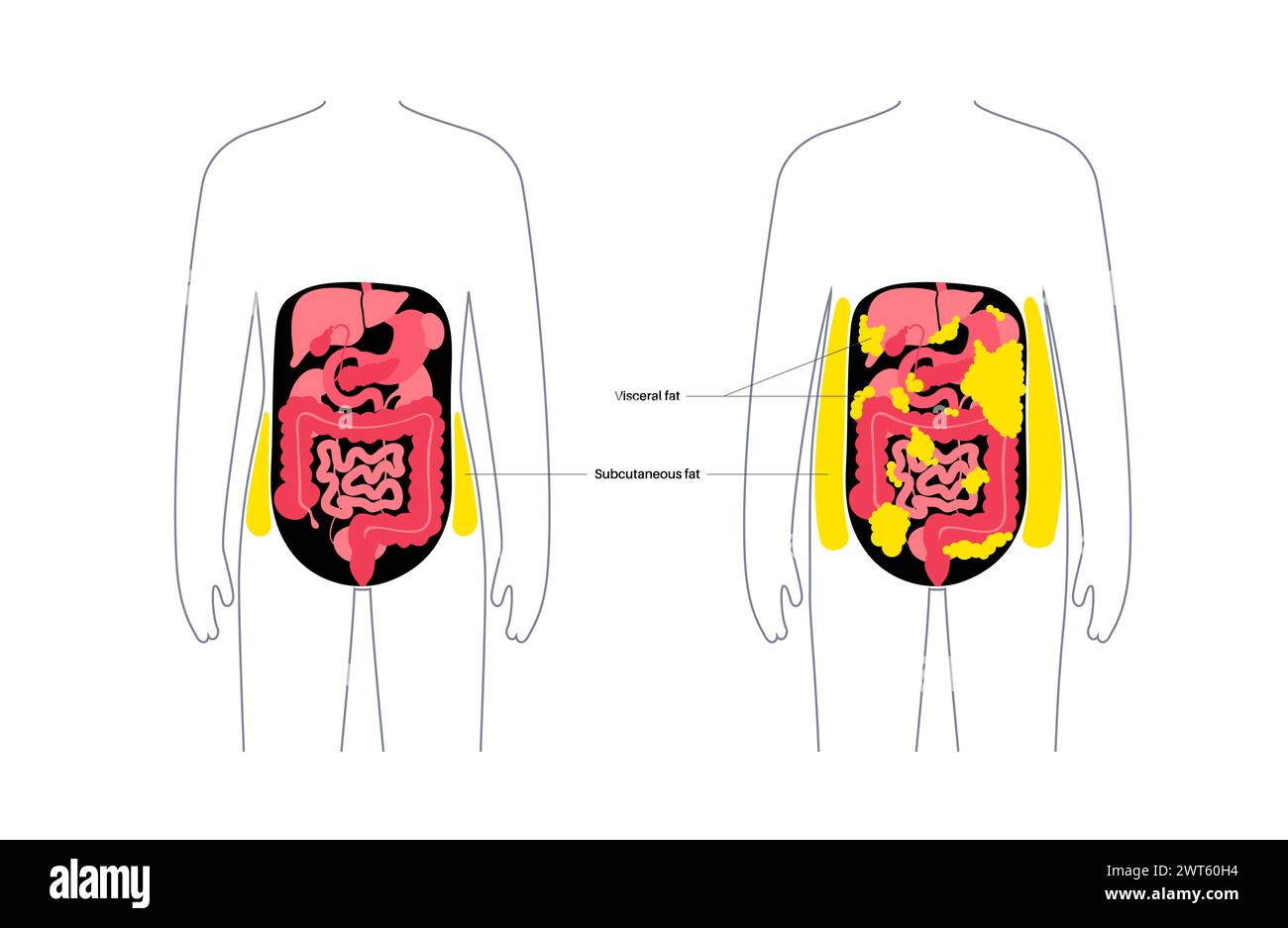 Visceral fat diagram, illustration. Belly fat surrounds internal organs ...