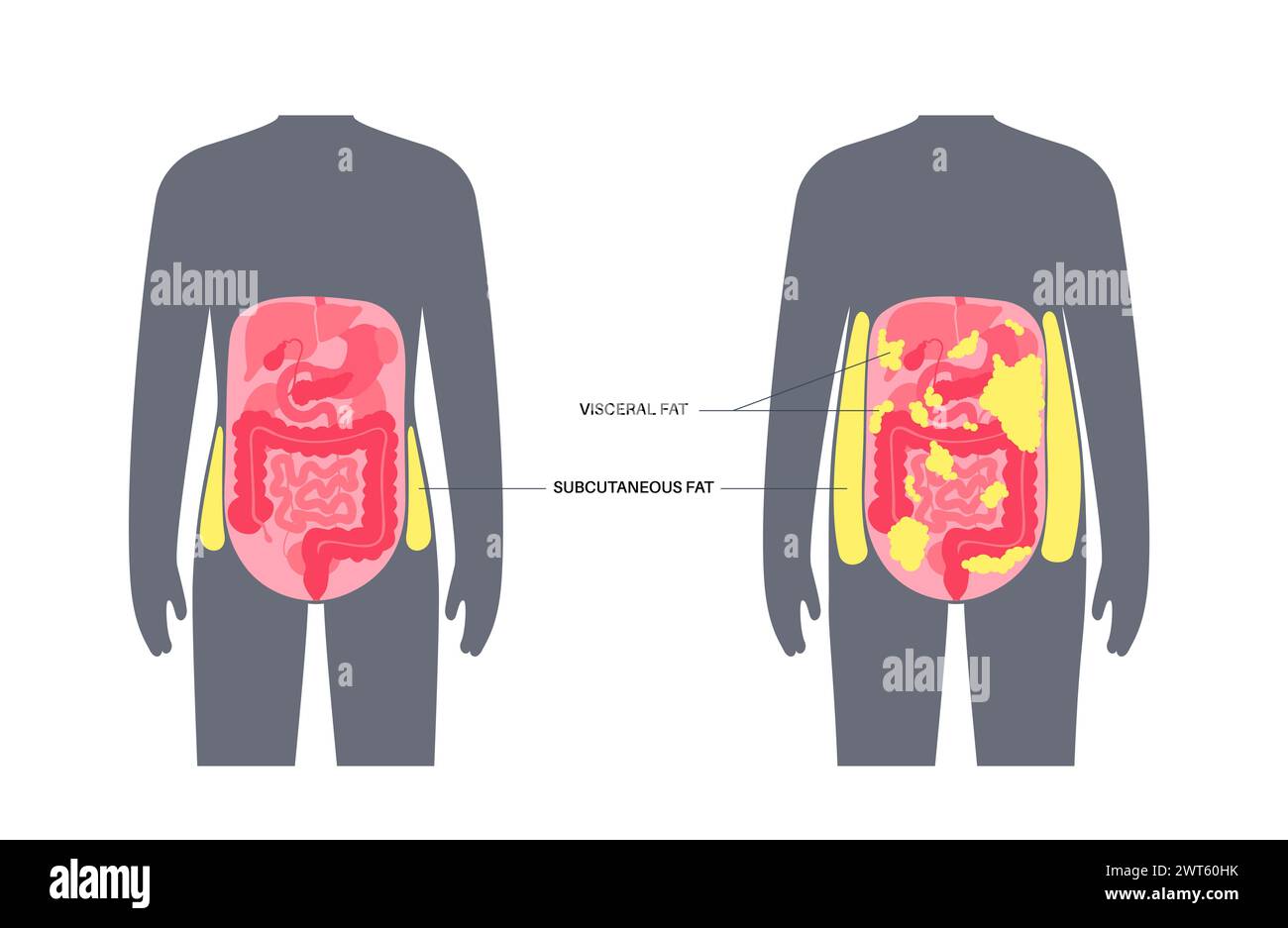 Visceral fat diagram, illustration. Belly fat surrounds internal organs ...