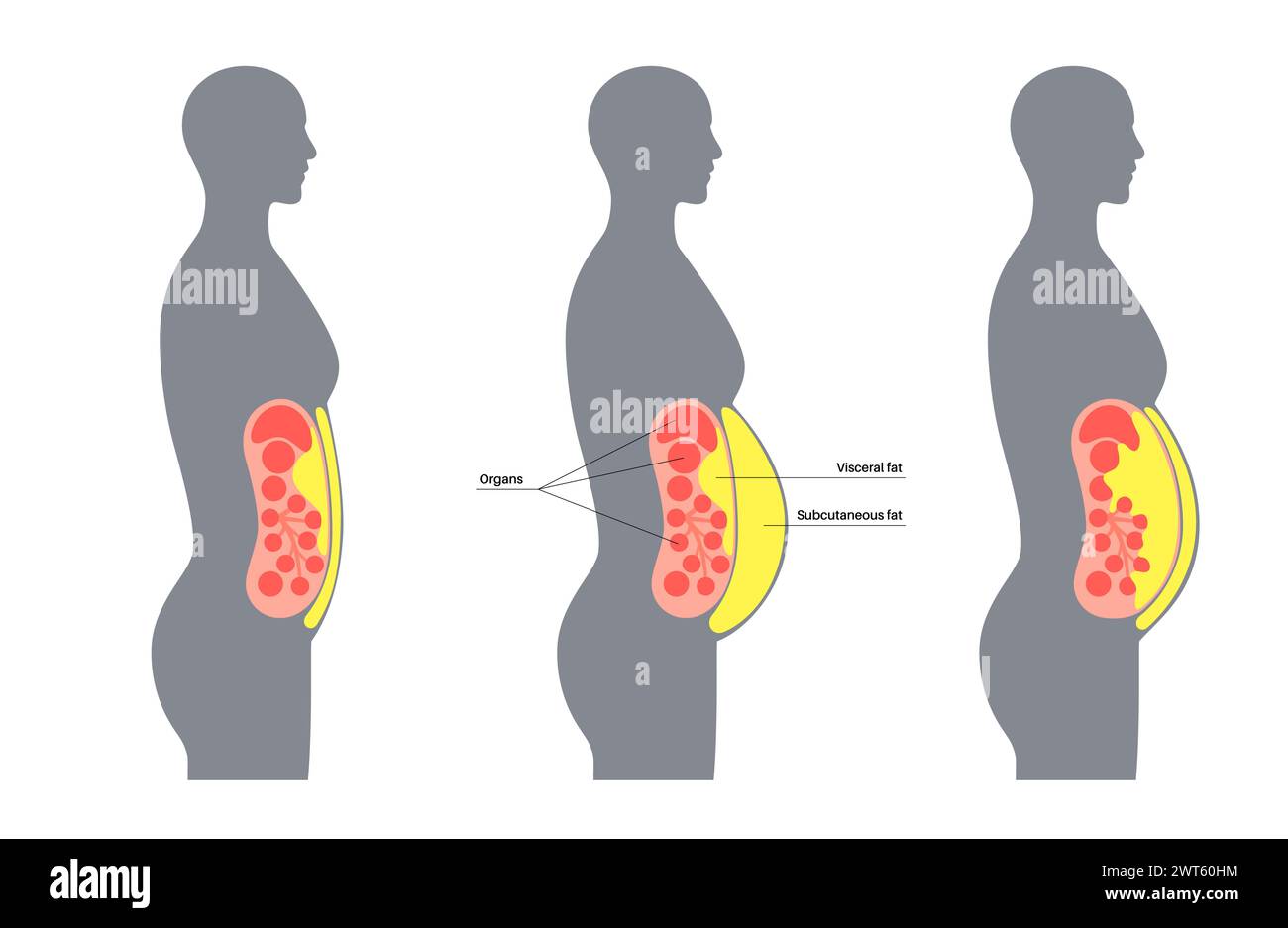 Visceral fat diagram, illustration. Belly fat surrounds internal organs ...