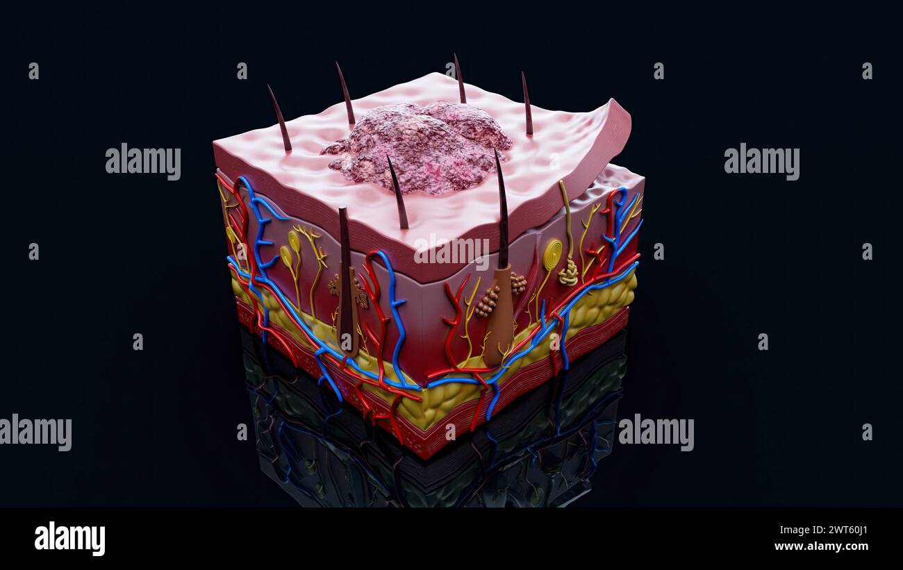 Skin lesion, illustration Stock Photo - Alamy