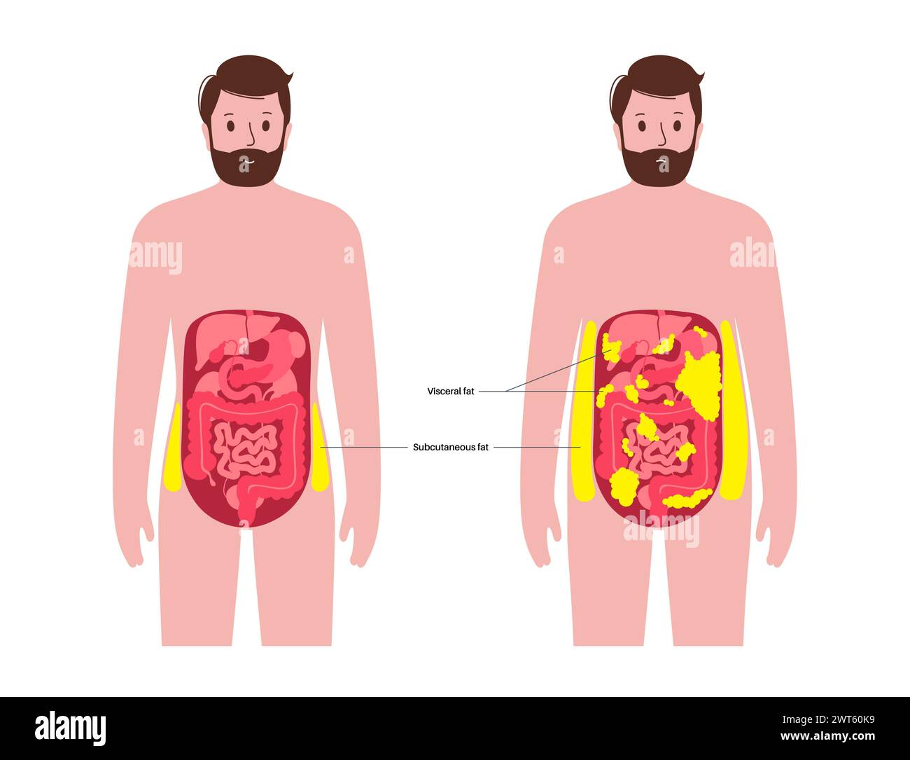 Visceral Fat Diagram Illustration Belly Fat Surrounds Internal Organs In Abdominal Cavity 