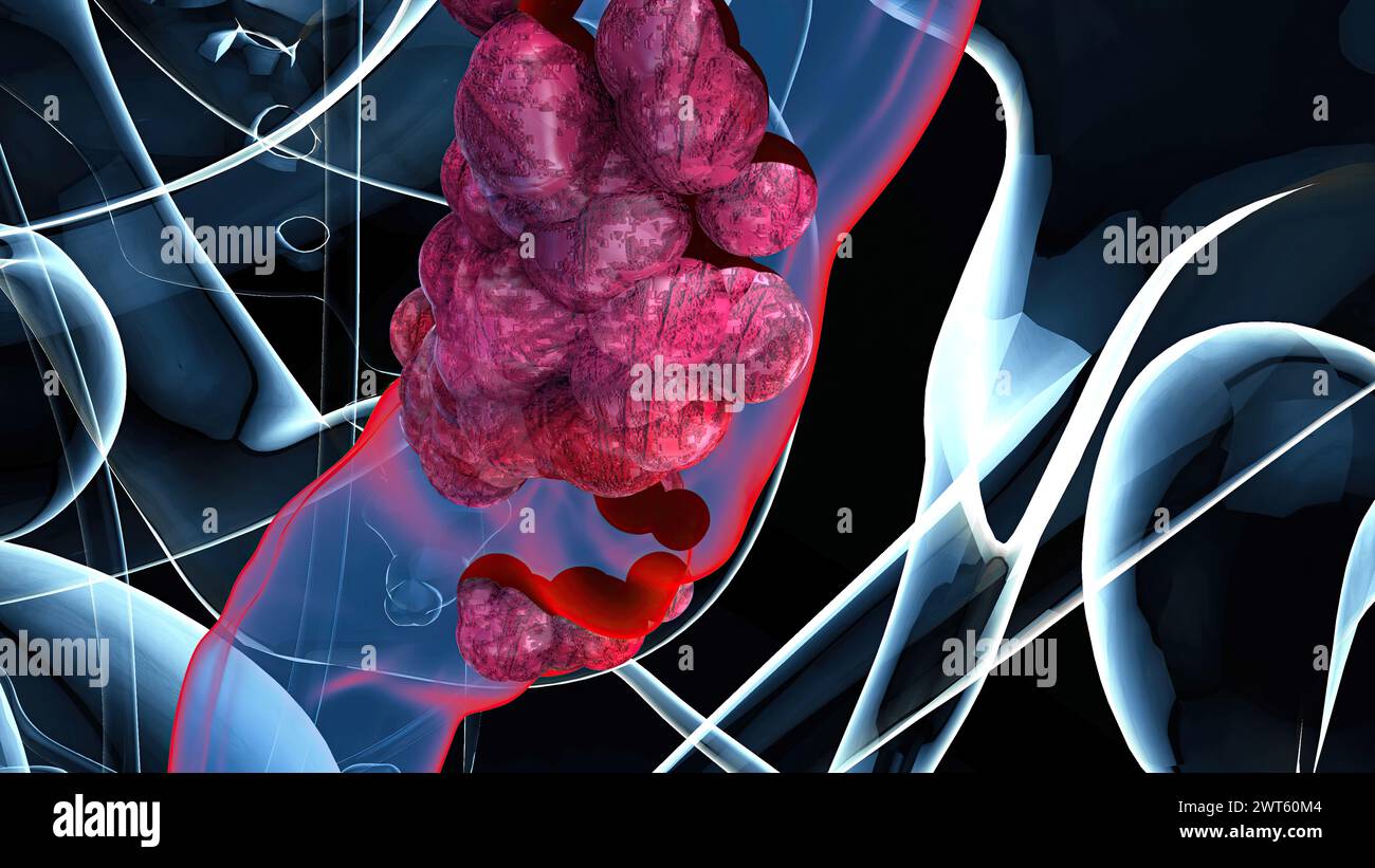 Colon cancer, conceptual illustration Stock Photo - Alamy