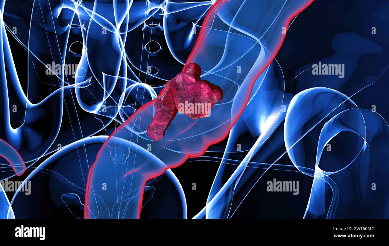 Colon cancer, conceptual illustration Stock Photo - Alamy