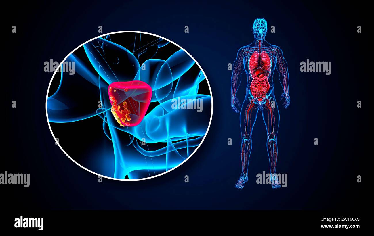 Prostate cancer, conceptual illustration Stock Photo - Alamy