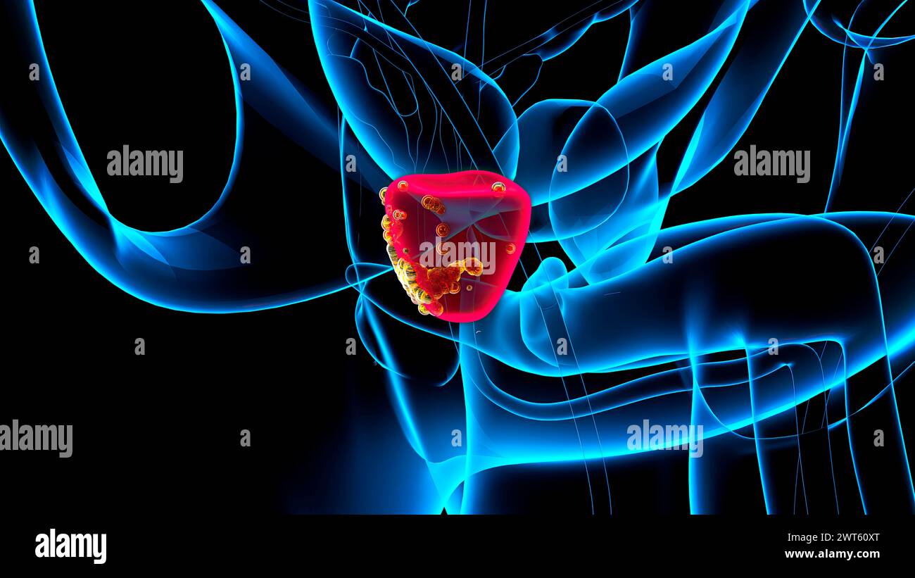 Prostate cancer, conceptual illustration Stock Photo - Alamy