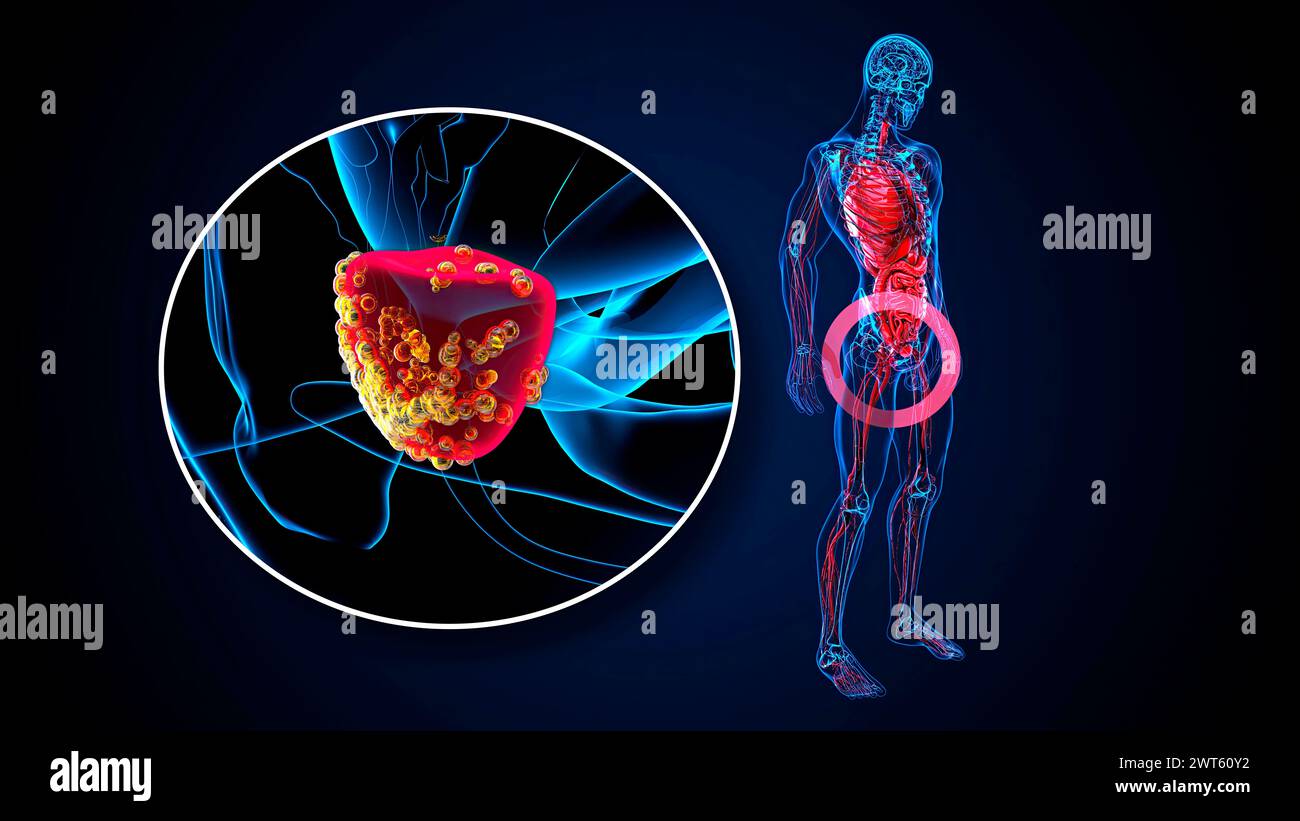Prostate cancer, conceptual illustration Stock Photo - Alamy