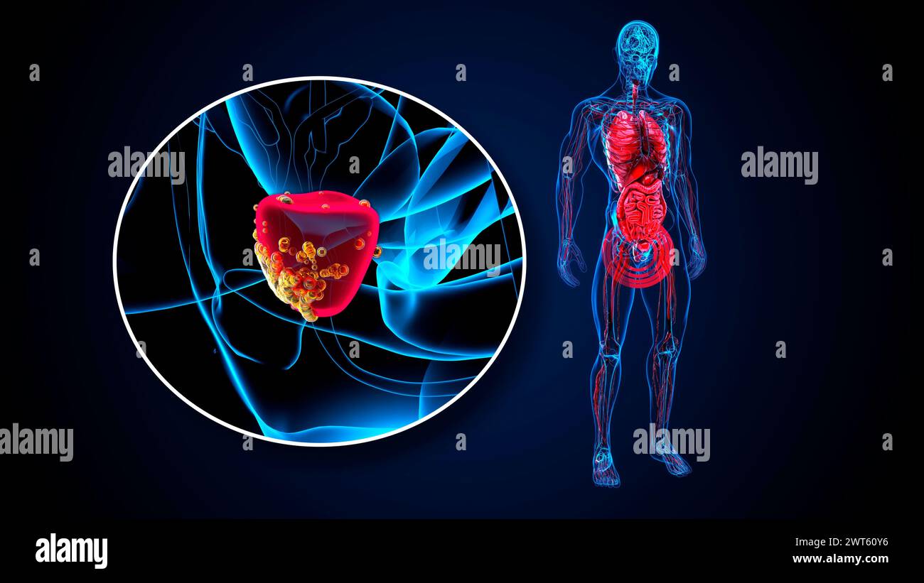 Prostate cancer, conceptual illustration Stock Photo - Alamy