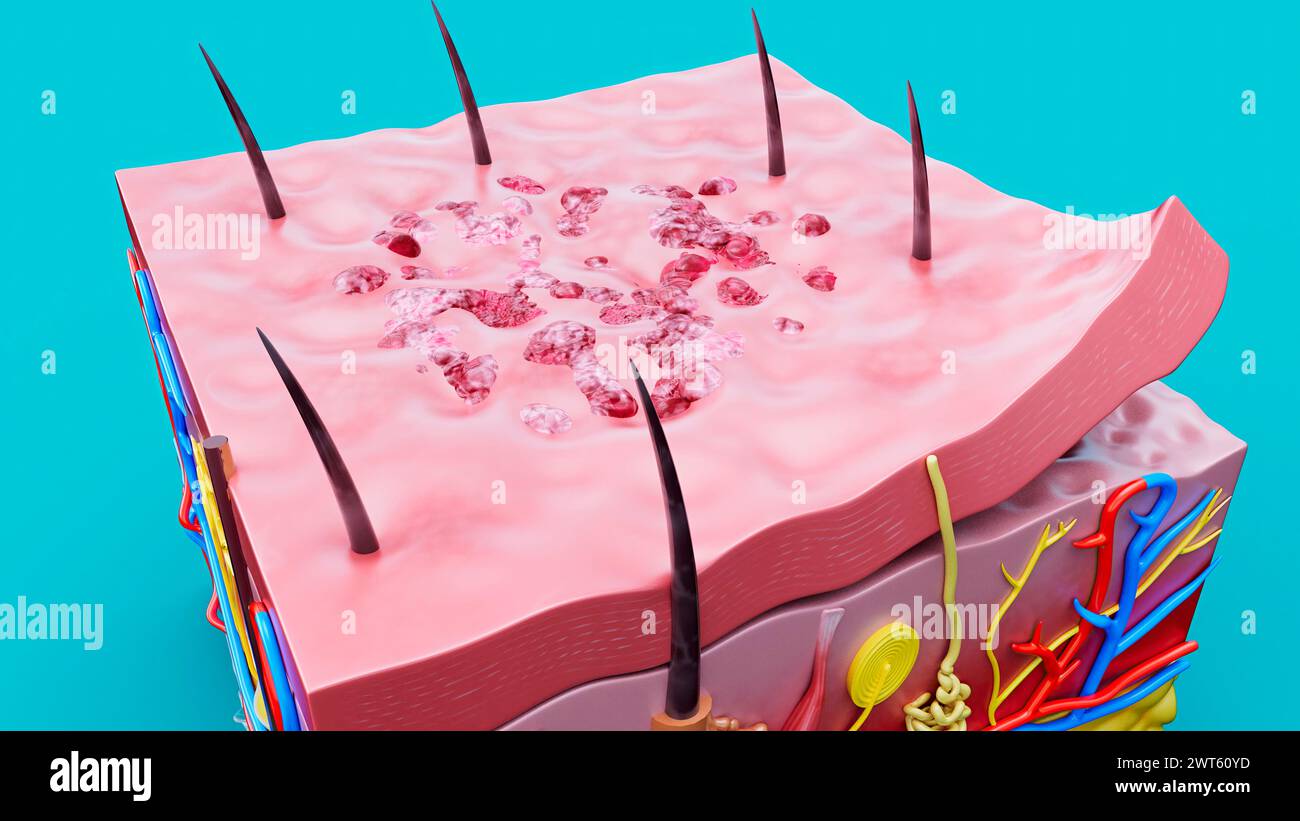 Skin lesion, illustration Stock Photo - Alamy