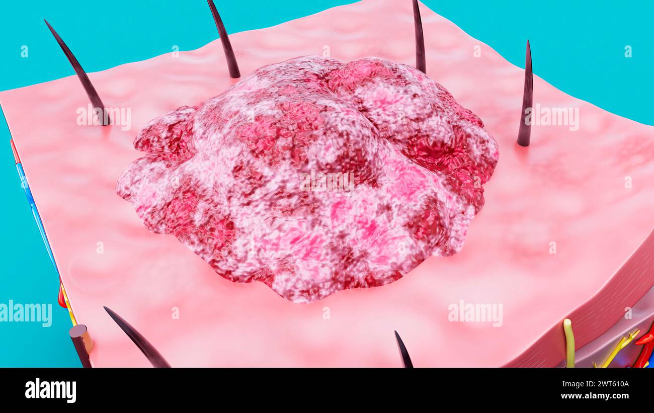 Lesion skin hi-res stock photography and images - Alamy