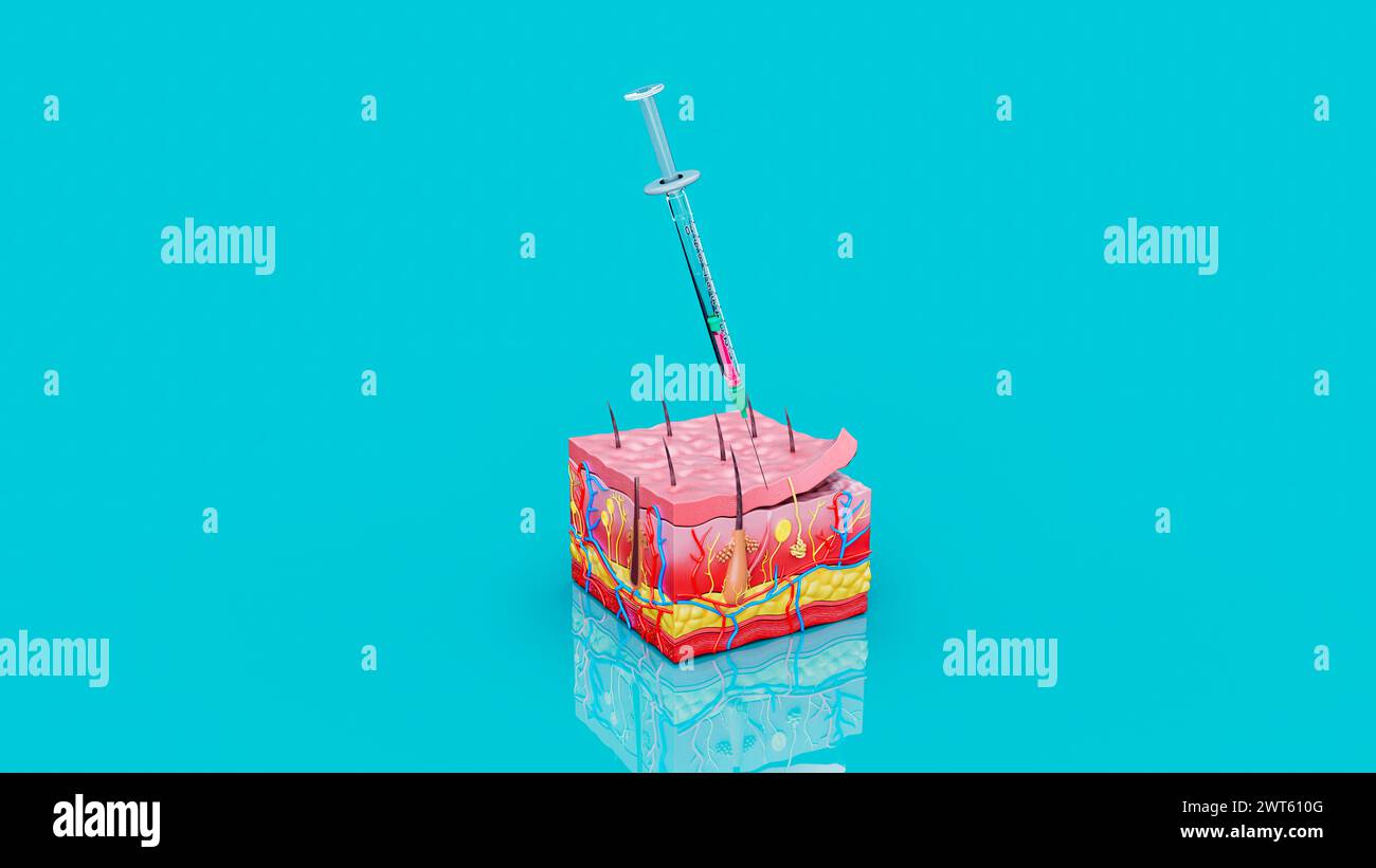 Illustration of an injection into the dermis of the skin Stock Photo ...