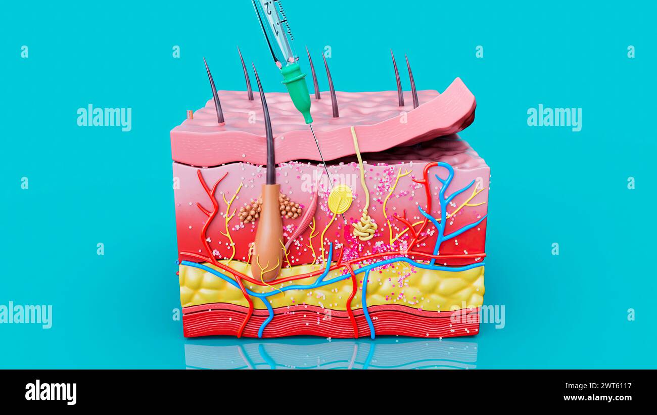 Illustration of an injection into the dermis of the skin Stock Photo ...