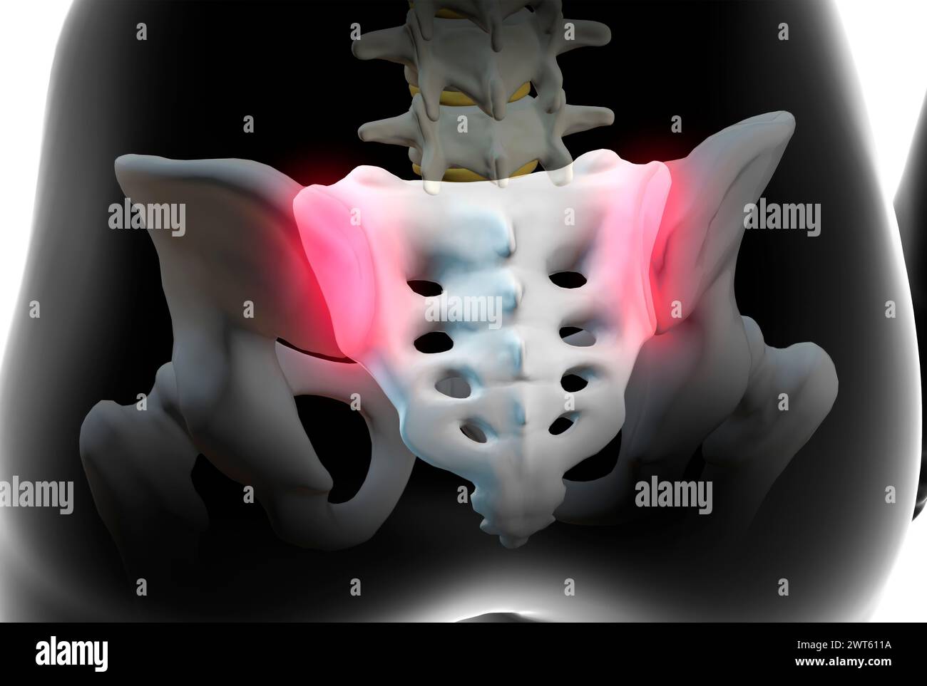 Inflammation of sacroiliac joints, illustration Stock Photo - Alamy