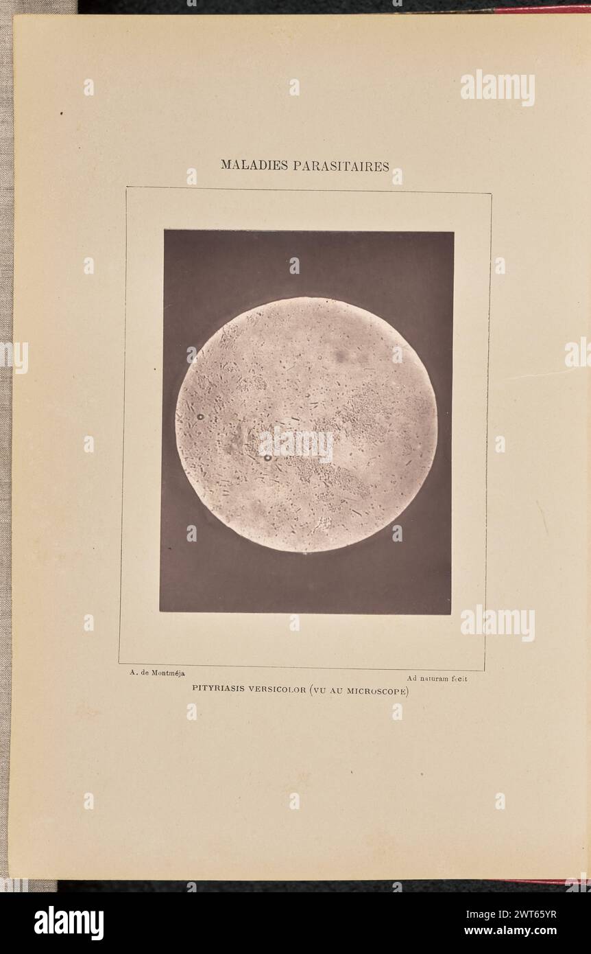 Pityriasis versicolor (vu au microscope). Arthur de Montmeja ...