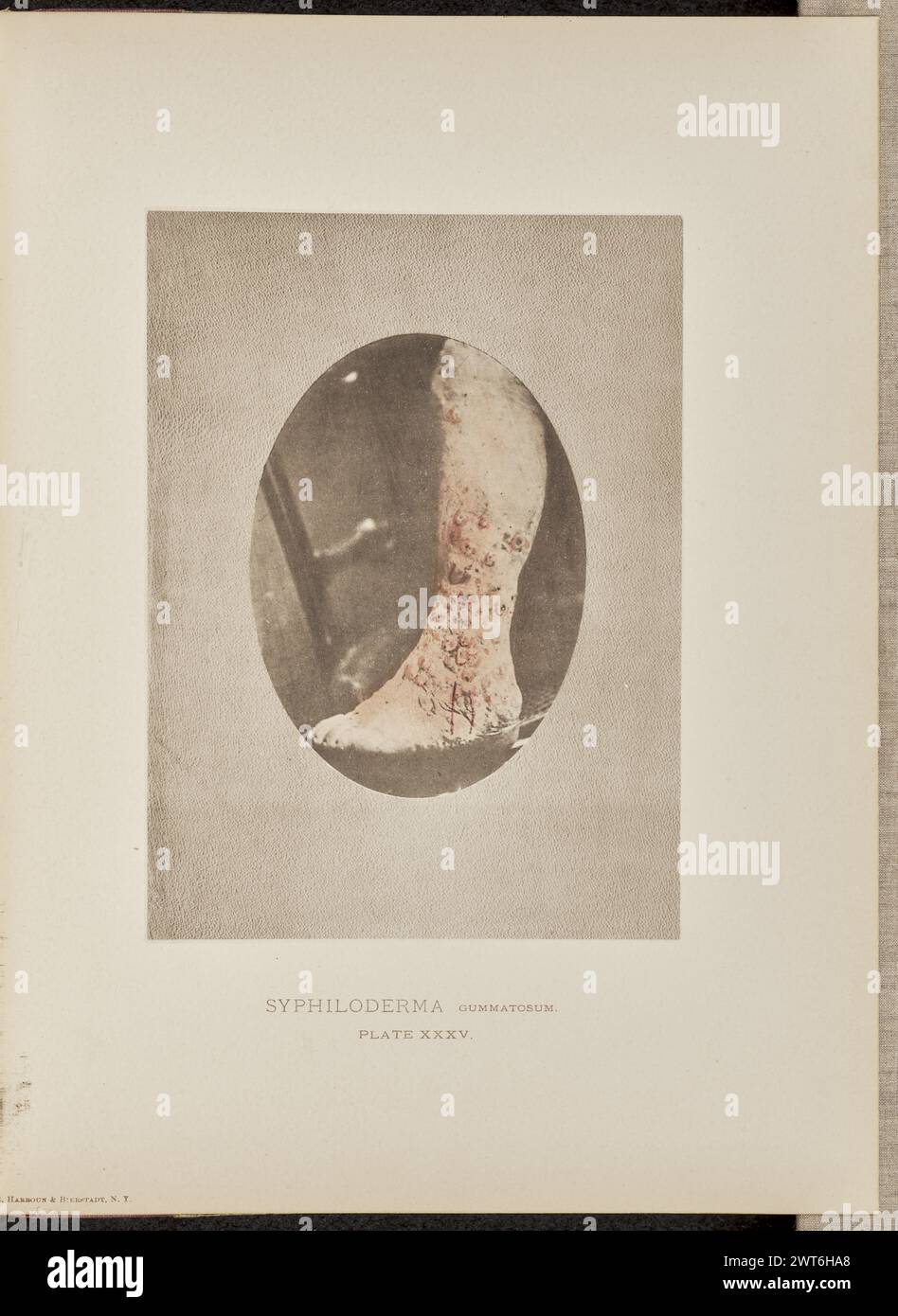 Syphiloderma gummatosum. Dr. George Henry Fox, photographer (American ...