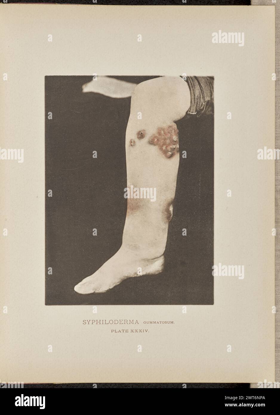 Syphiloderma gummatosum. O.G. Mason, photographer (American, 1830 ...