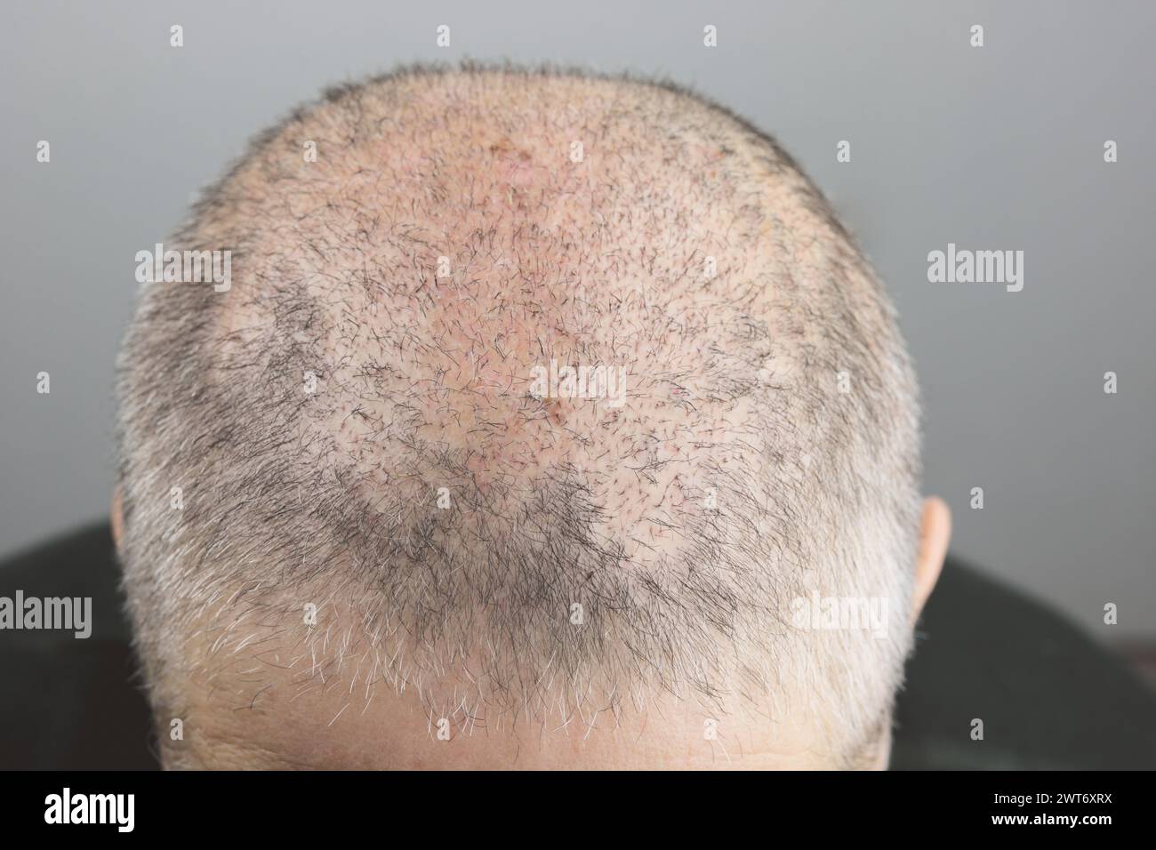 Exttraction hi-res stock photography and images - Alamy