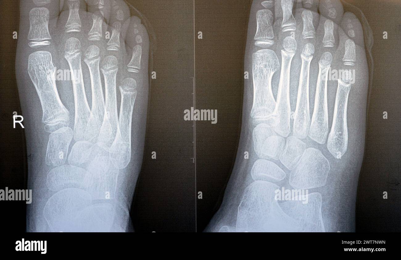 Plain x ray of the right foot of a 9 years old child shows normal ...
