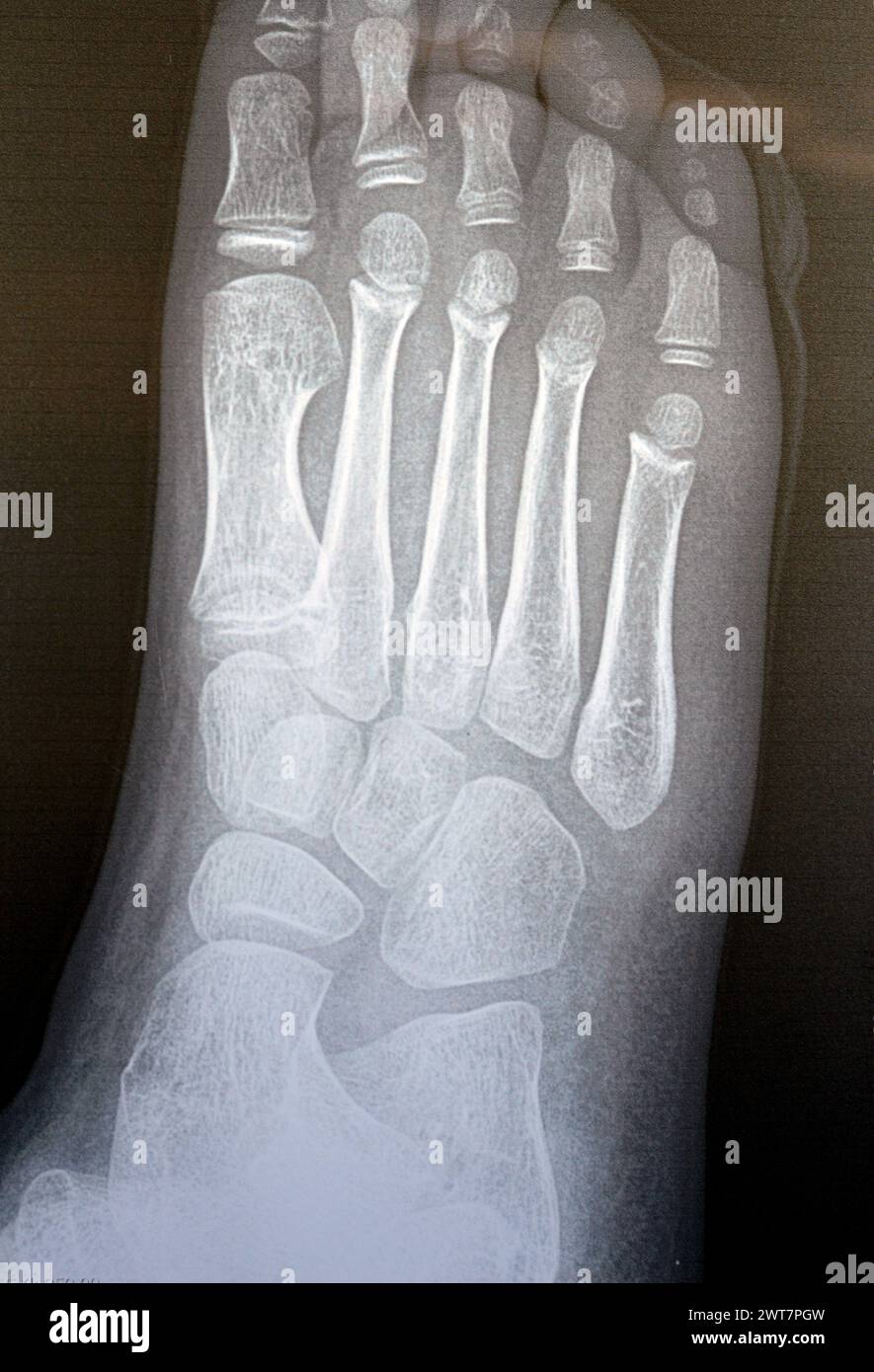 Plain x ray of the right foot of a 9 years old child shows normal ...