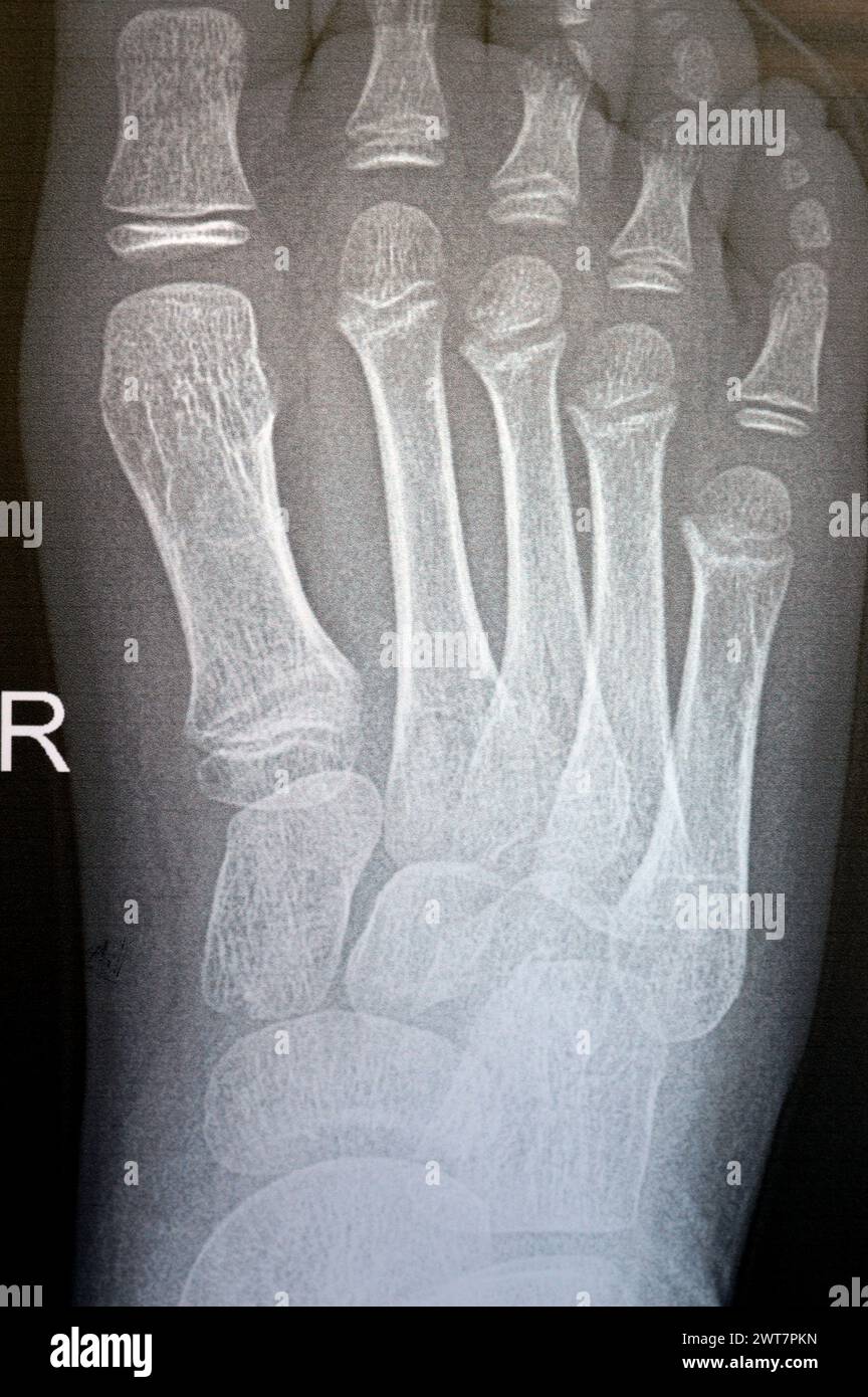 Plain x ray of the right foot of a 9 years old child shows normal ...