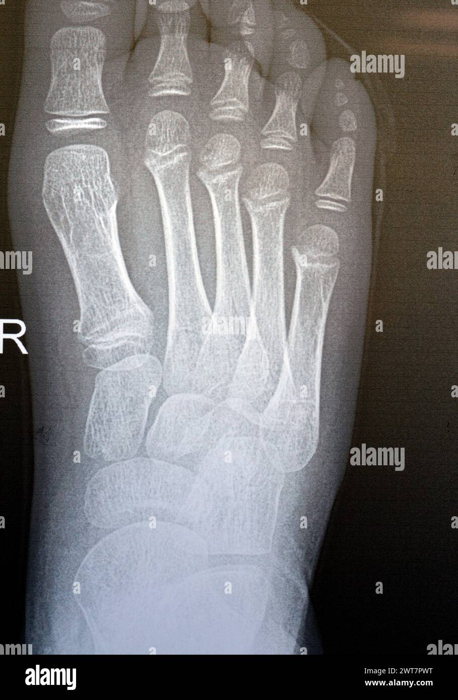 Plain x ray of the right foot of a 9 years old child shows normal ...