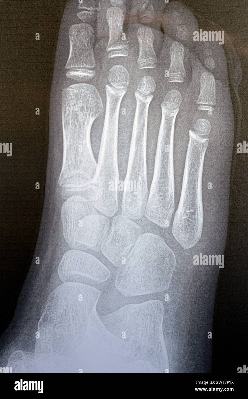 Normal Foot Xray X Ray Of 1st Patient's Feet At The Age Of 7 Years
