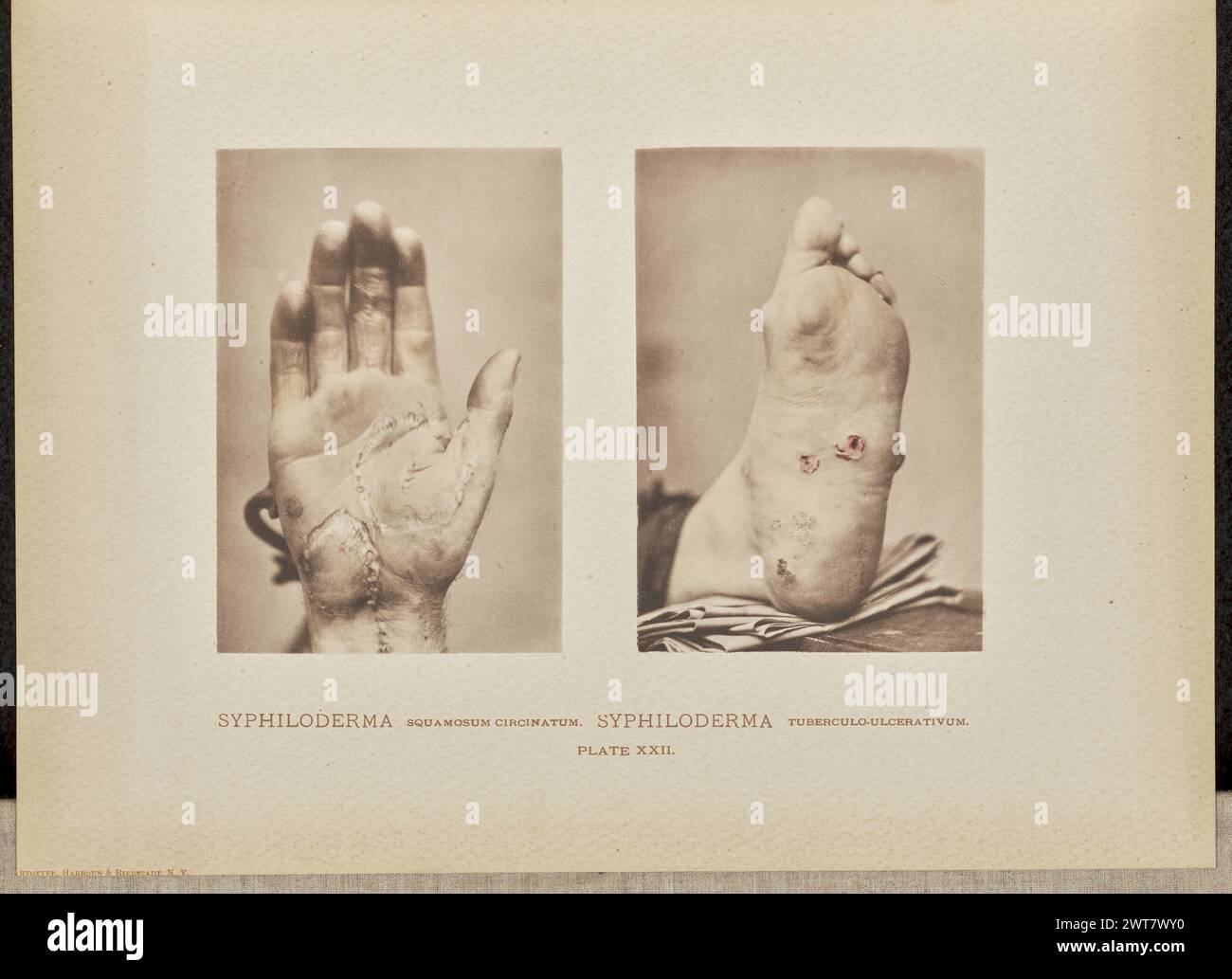 Syphiloderma squamosum circinatum and syphiloderma tuberculo ...