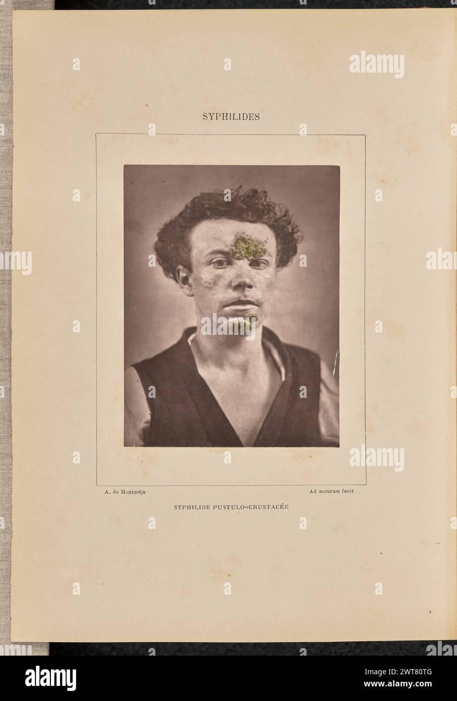 Forehead cheeks hi-res stock photography and images - Alamy