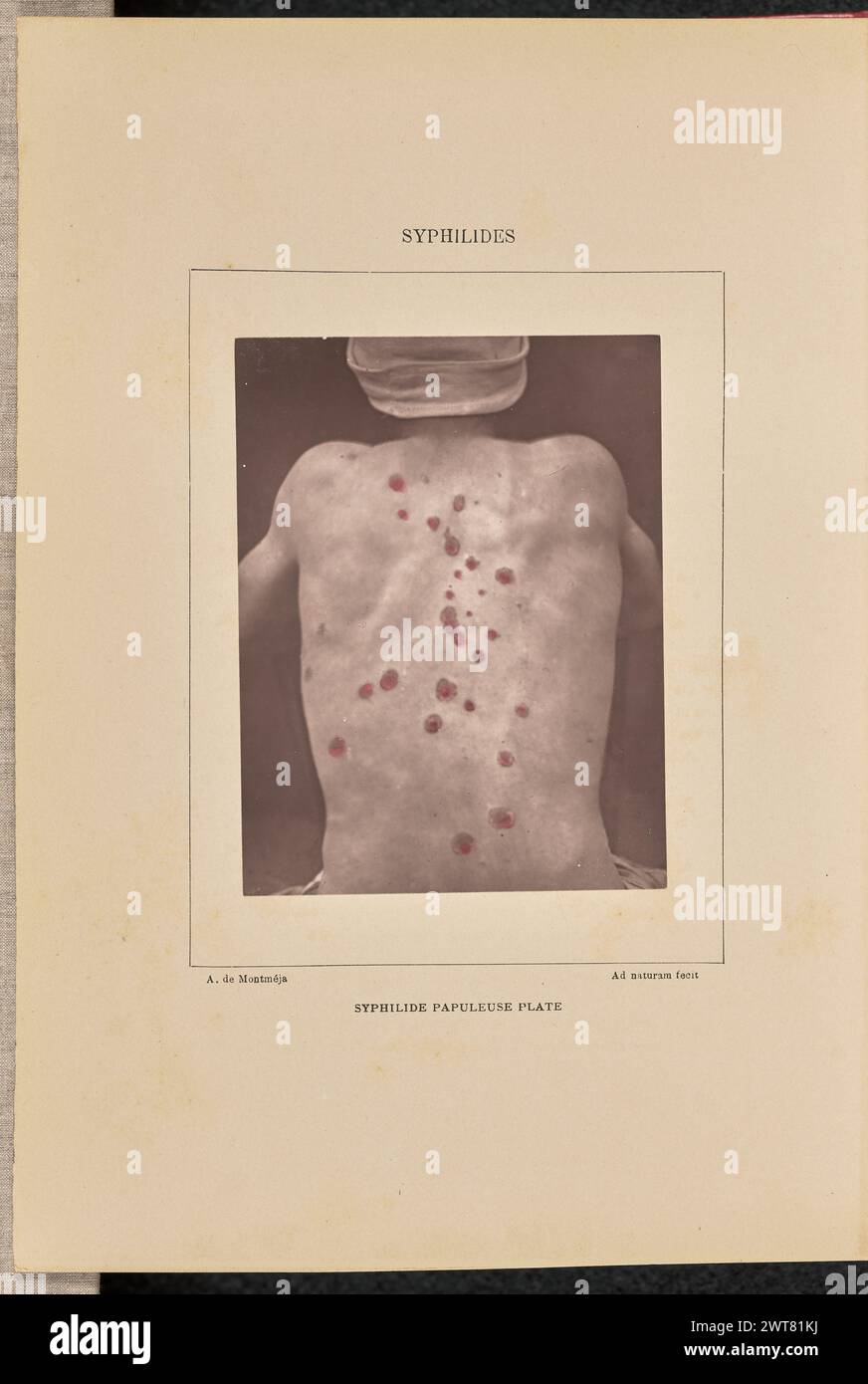 Syphilide papuleuse plate. Arthur de Montmeja, photographer (French ...