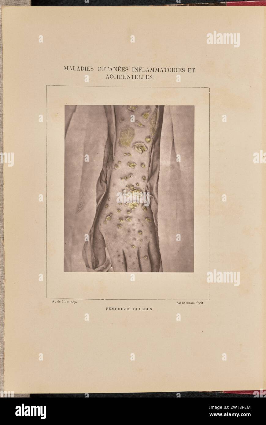 Bullous hi-res stock photography and images - Alamy