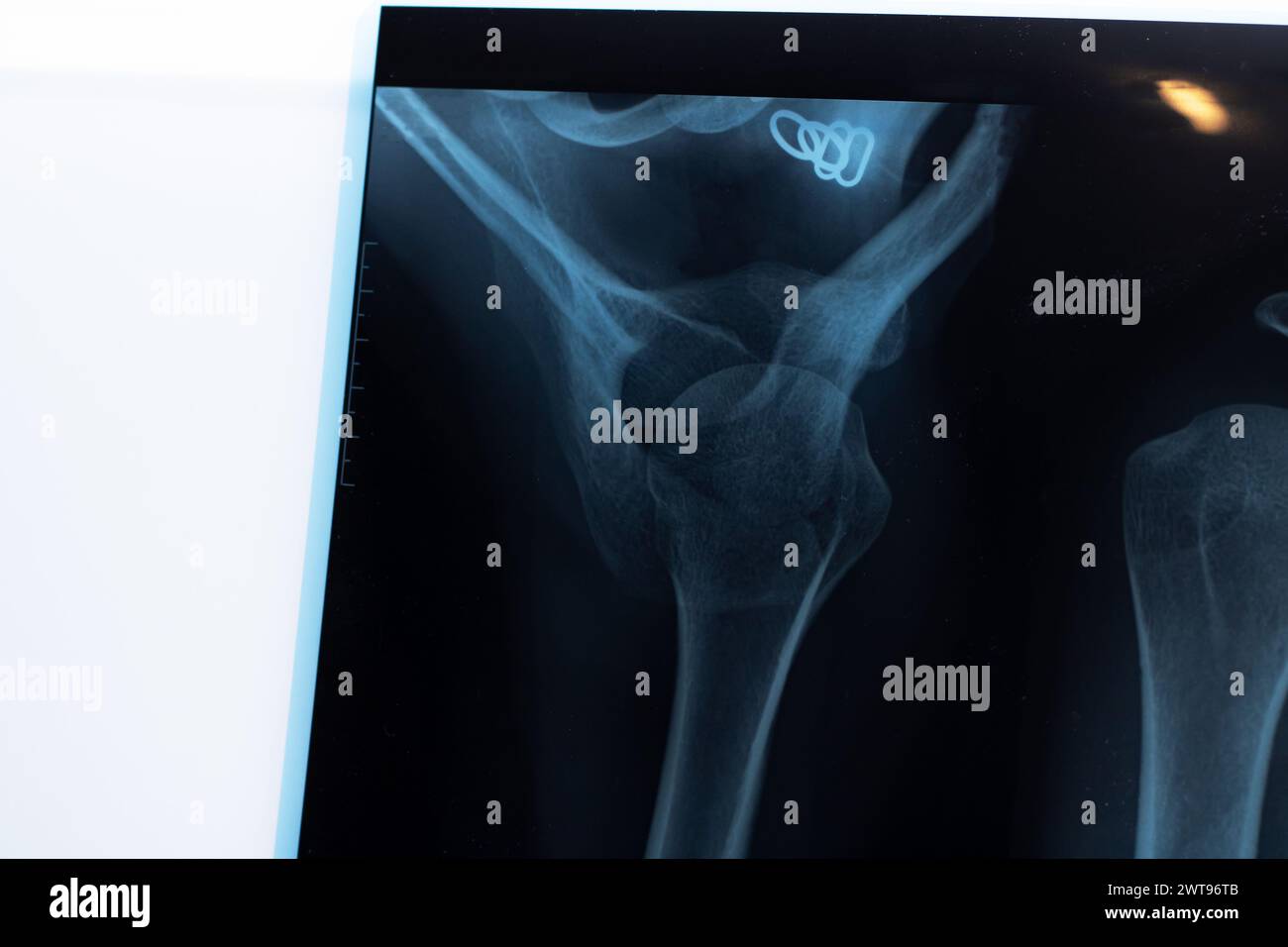 Normal shoulder x ray hi-res stock photography and images - Alamy