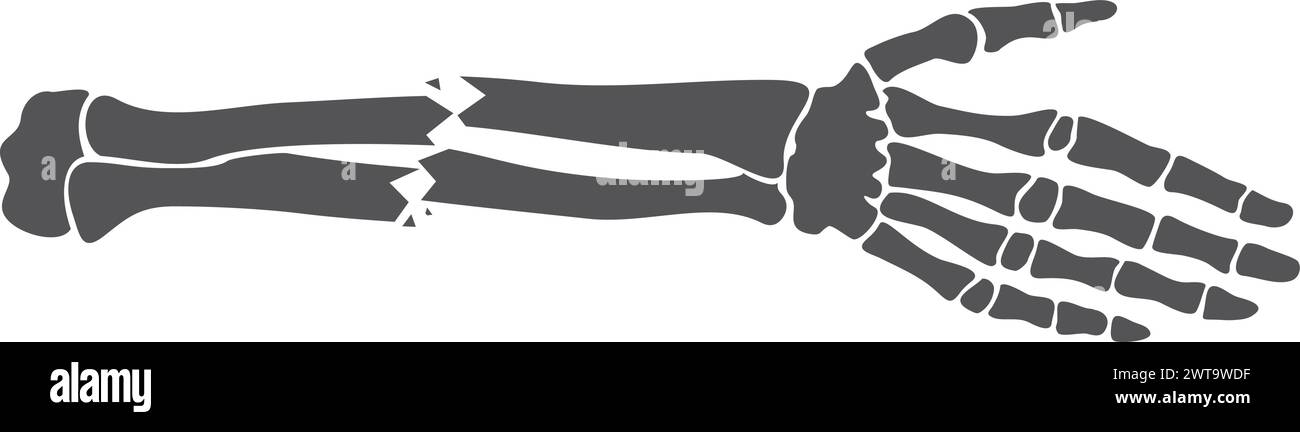 Broken hand bones. Bone fracture. Injury icon Stock Vector Image & Art ...