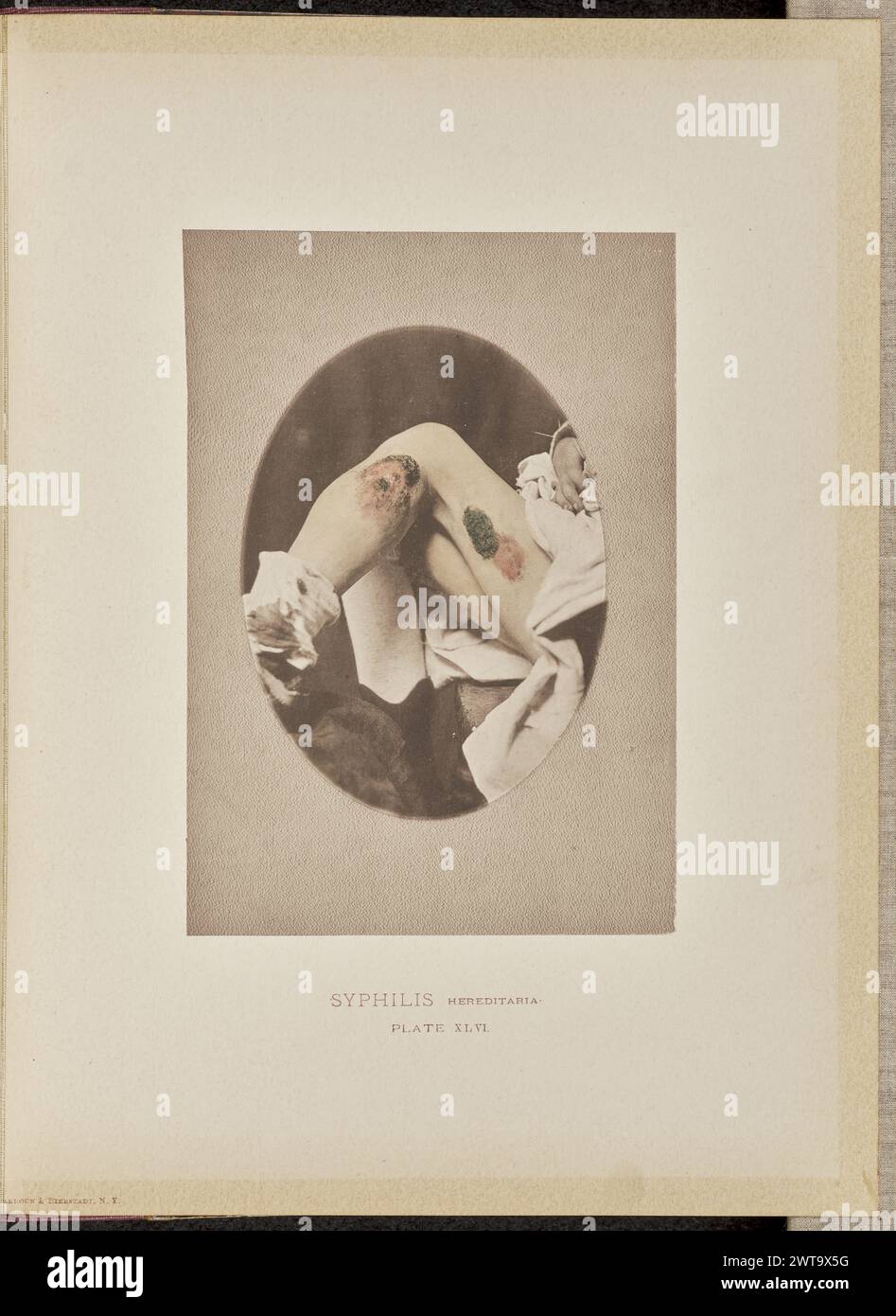 Syphilis hereditaria. Dr. George Henry Fox, photographer (American ...