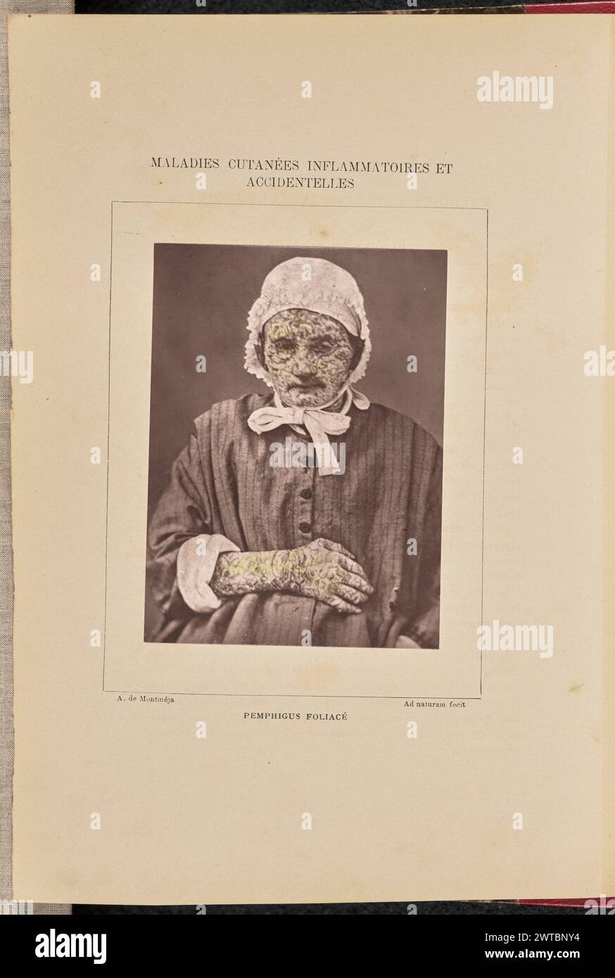 Pemphigus foliacé hi-res stock photography and images - Alamy Pemphigus foliacé hi-res stock photography and images - Alamy