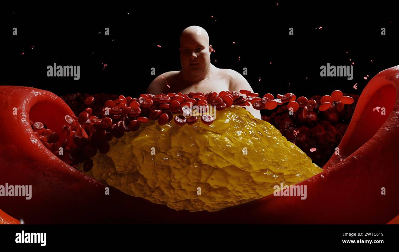 Fat man, blood stream and cholesterol plaque, thrombus. health harm ...