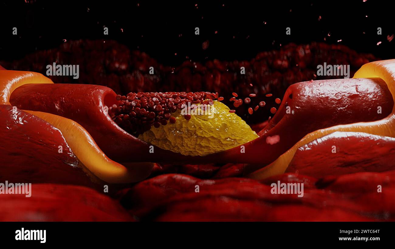 blood stream and cholesterol plaque, thrombus. health harm concept ...