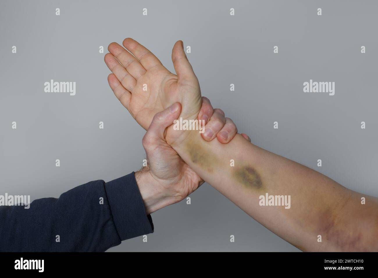 Female hand with bruise. Domestic violence and abuse concept Stock ...