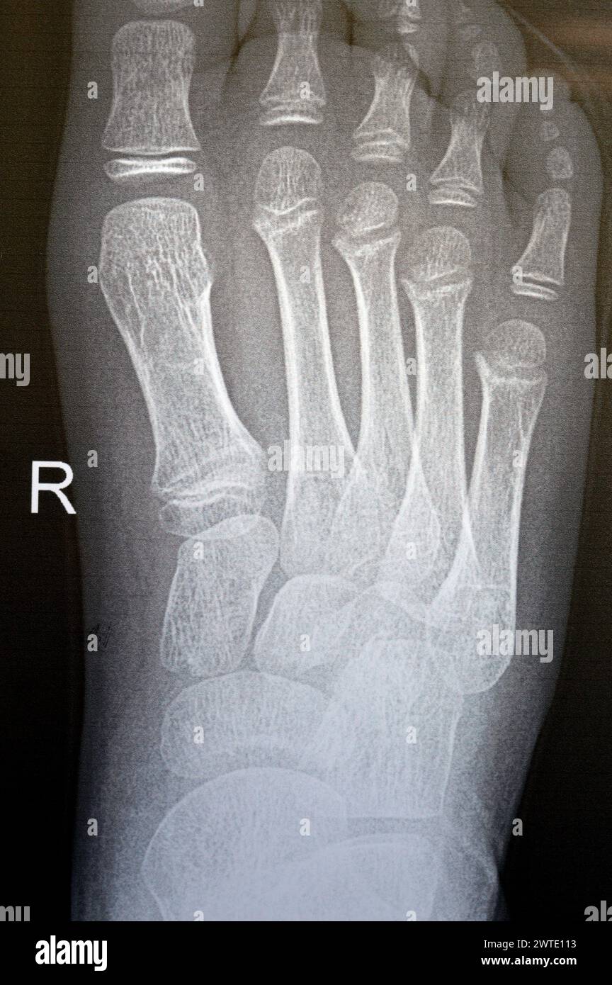 Plain x ray of the right foot of a 9 years old child shows normal ...