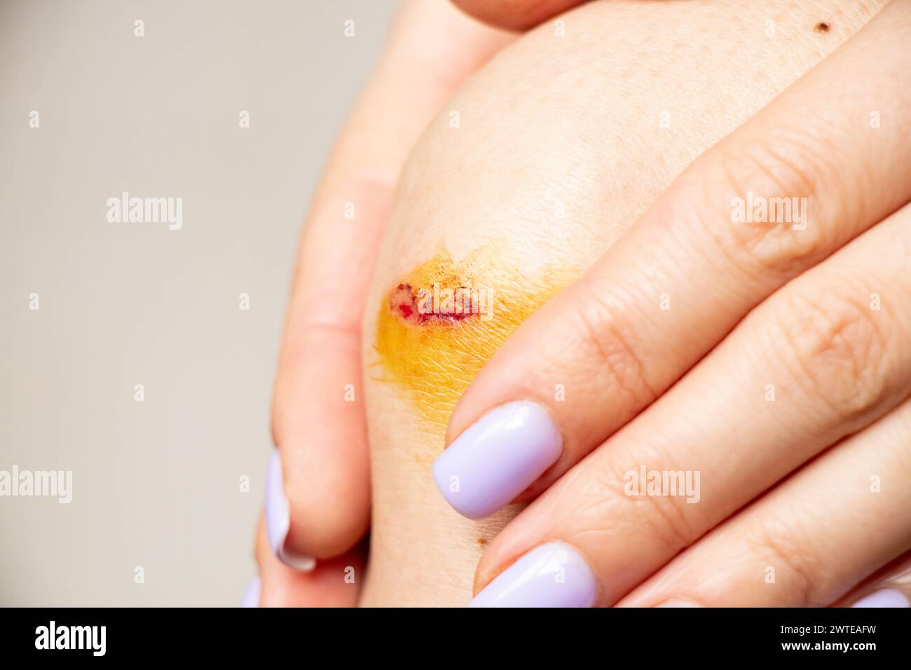 Close-up of a wound with blood on a girl's knee after a fall, accident ...