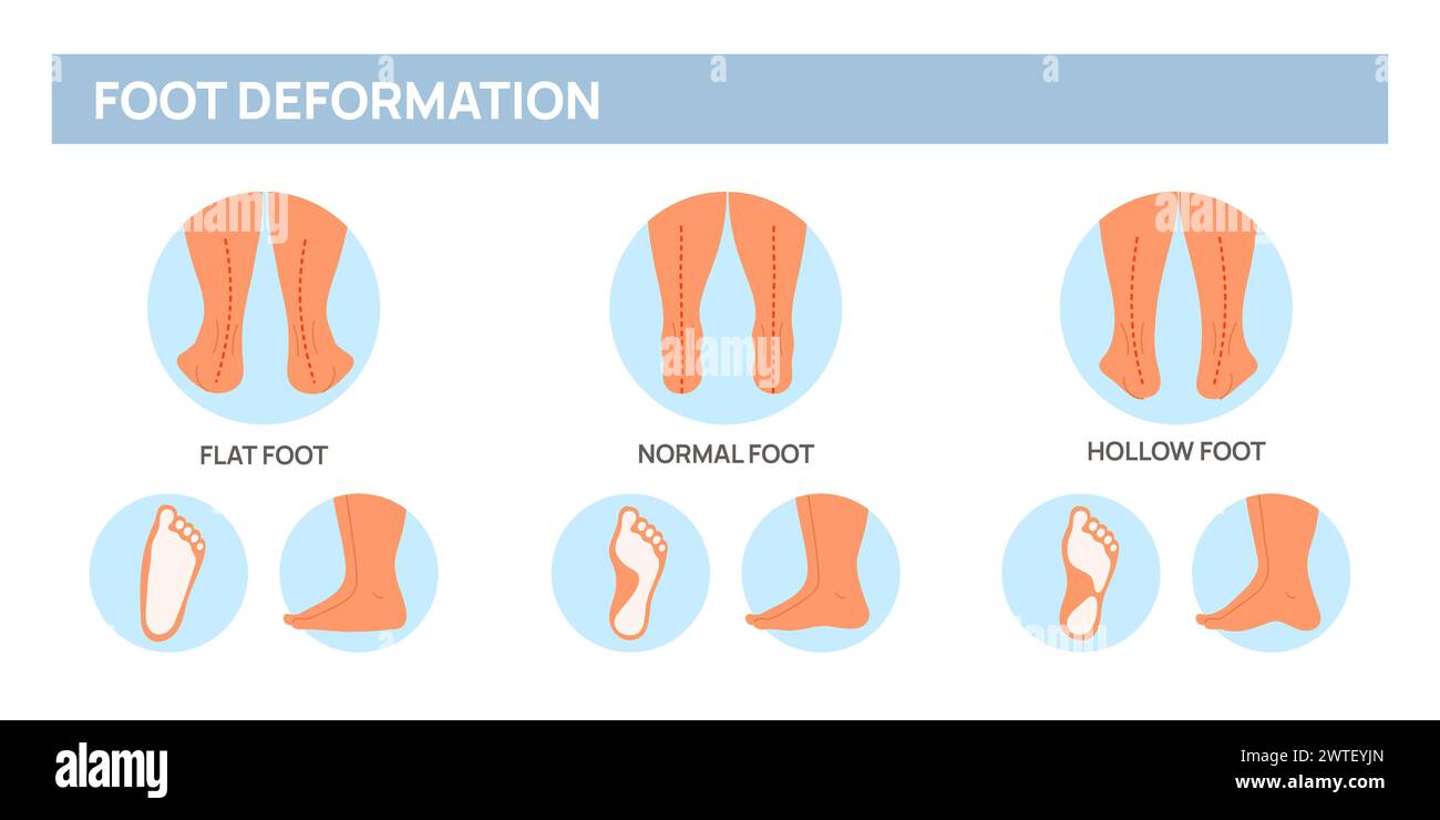 Foot deformation poster. Medical scheme with leg curvature types. Flat ...
