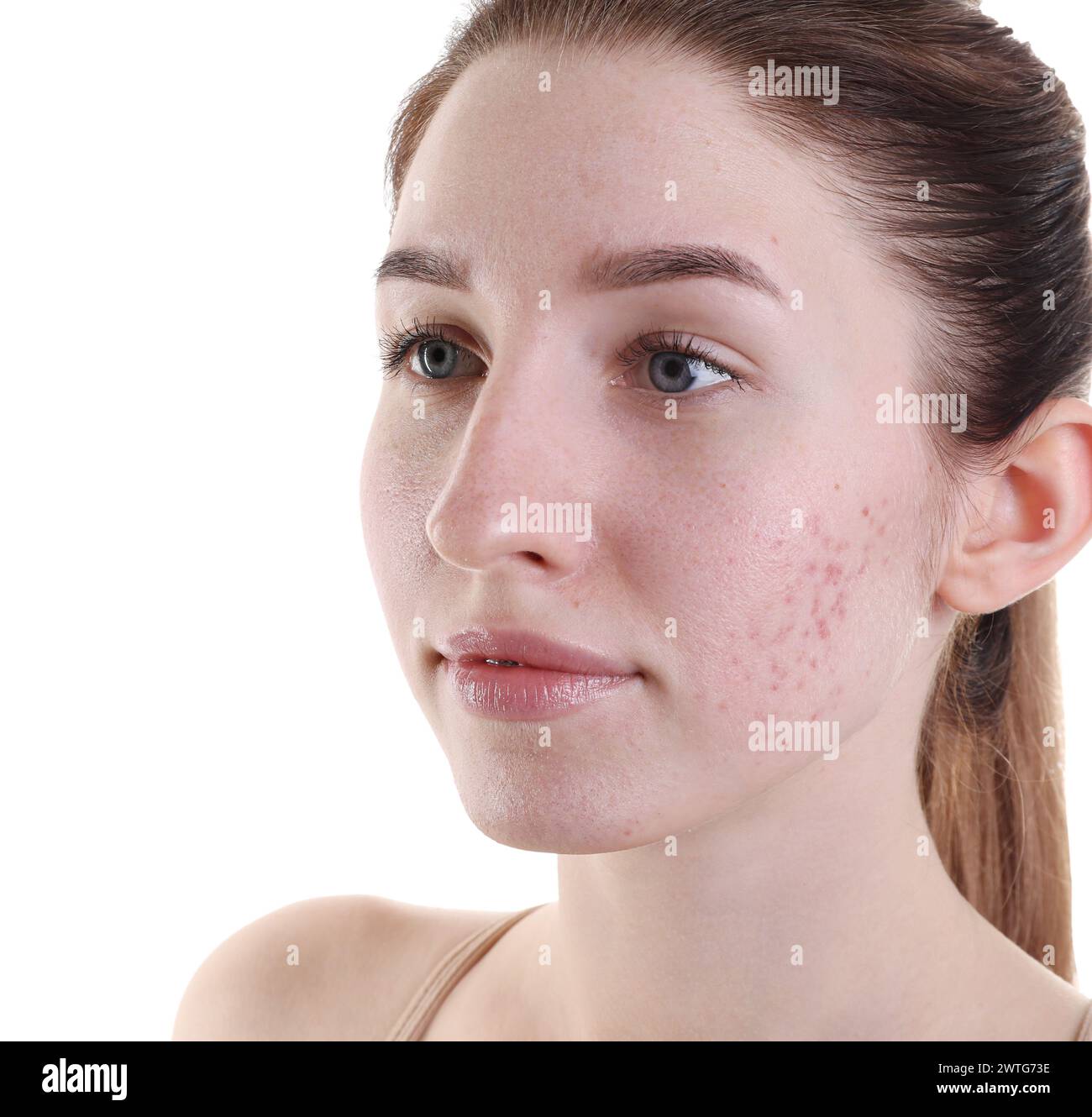 Young woman with acne problem on white background Stock Photo - Alamy